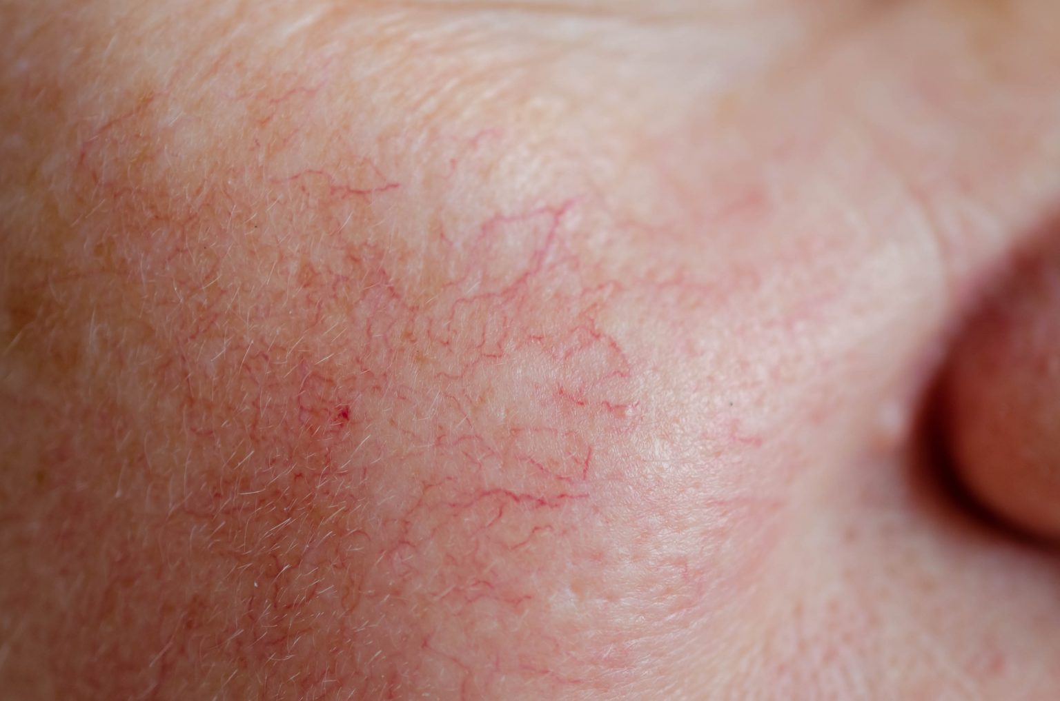 The Most Time Efficient Way To Treat Your Rosacea - Azure Medical