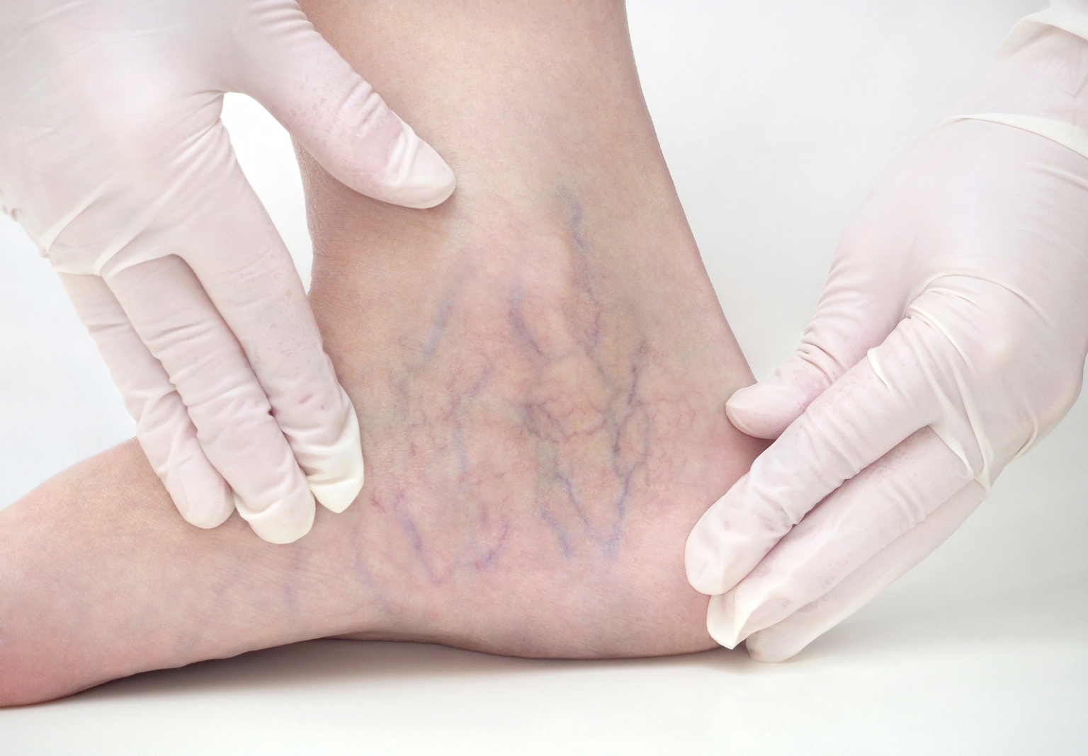 What is Sclerotherapy? - Azure Medical